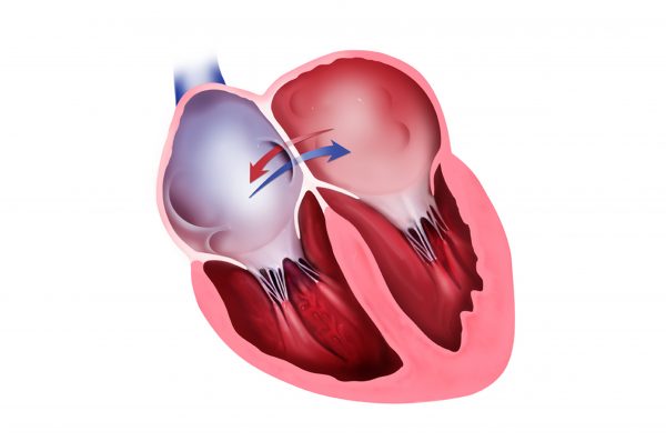 Comunicação Interatrial - CIA - Pro Criança Cardíaca